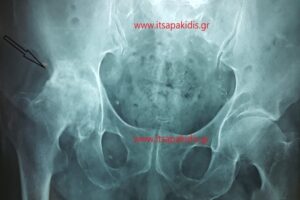 Πόνος Στο Ισχίο - Ποιες Είναι Οι Συχνότερες Αιτίες;